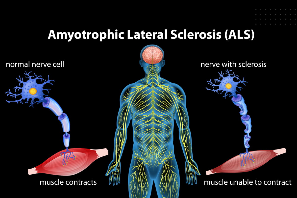 ALS Symptoms Stages And Progression Lone Star Neurology ALS Symptoms Stages And Progression Lone Star Neurology