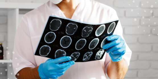 What are the symptoms of mild strokes? - Lone Star Neurology
