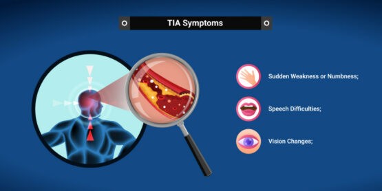 What Are Key Transient Ischemic Attack Symptoms?