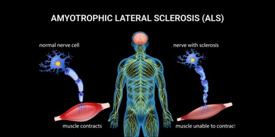 Diagnosis of ALS: Findings from Lone Star Neuroscience.