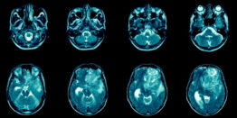Devic`s disease - Lone Star Neurology