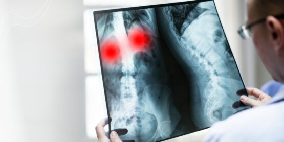 Spinal Stenosis: Symptoms, Risk Factors, Causes, Treatment