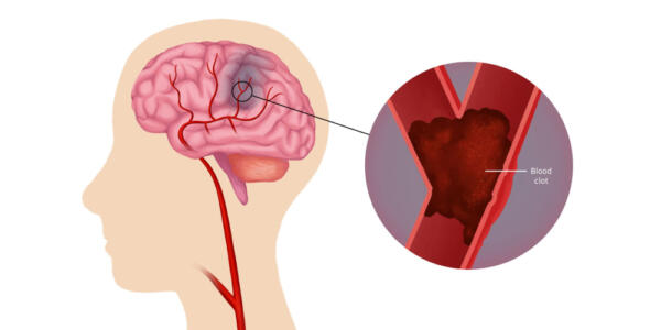 5 Types Of Stroke: Symptoms, Causes And How To Treat