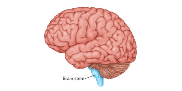 5 Types Of Stroke: Symptoms, Causes And How To Treat