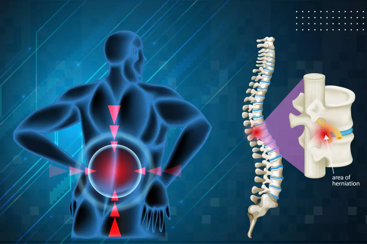 Spinal Cord Disorders: Symptoms, Causes and Treatment