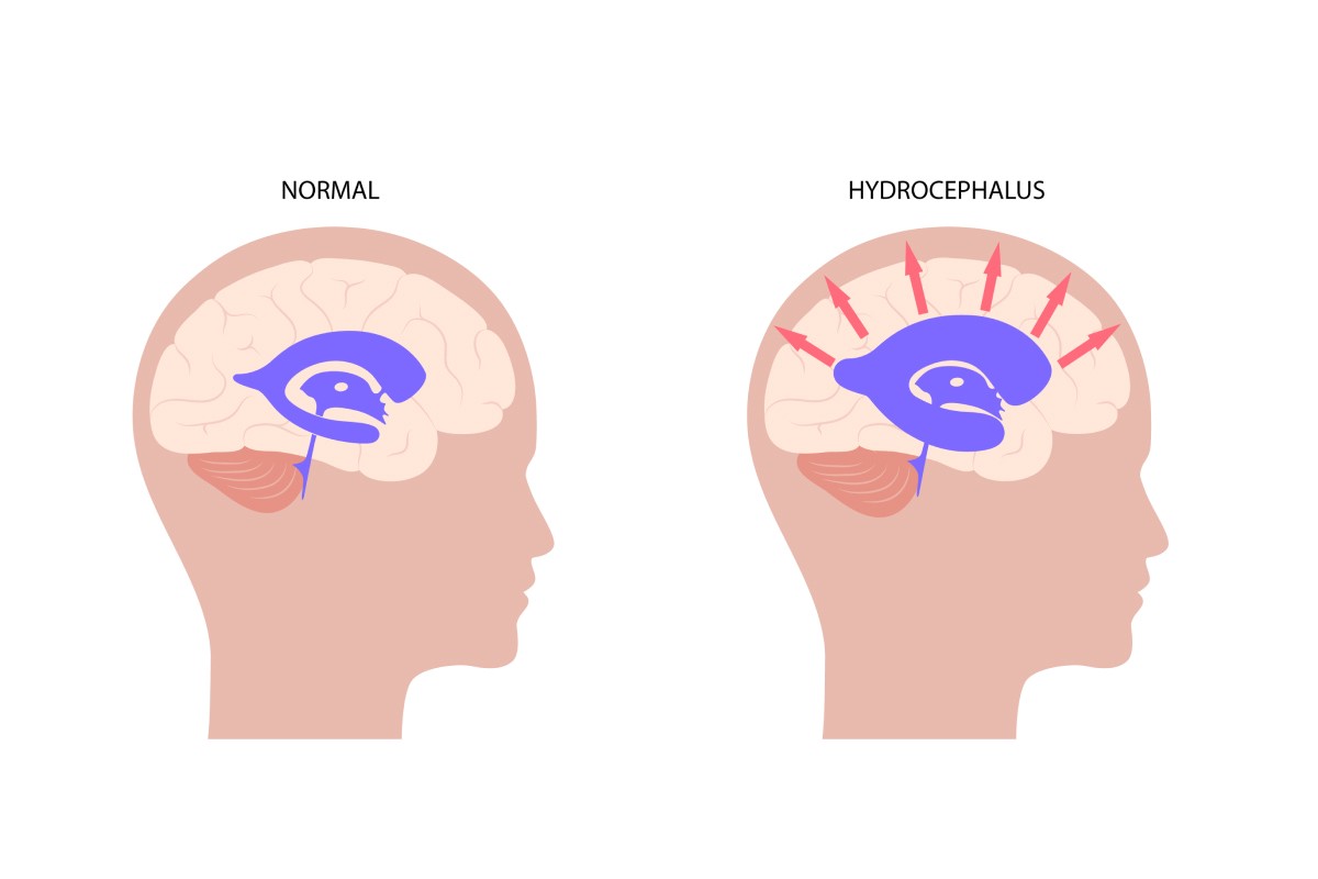 What is Hydrocephalus? Causes, Symptoms, Treatment