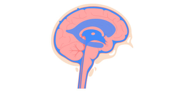 What is Hydrocephalus? Causes, Symptoms, Treatment