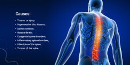 Spinal Cord Disorders: Symptoms, Causes and Treatment