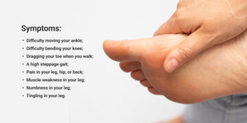 Foot Drop: Signs, Symptoms, and Causes Explained