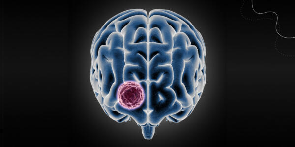 Brain Cancer Progression: What To Expect?