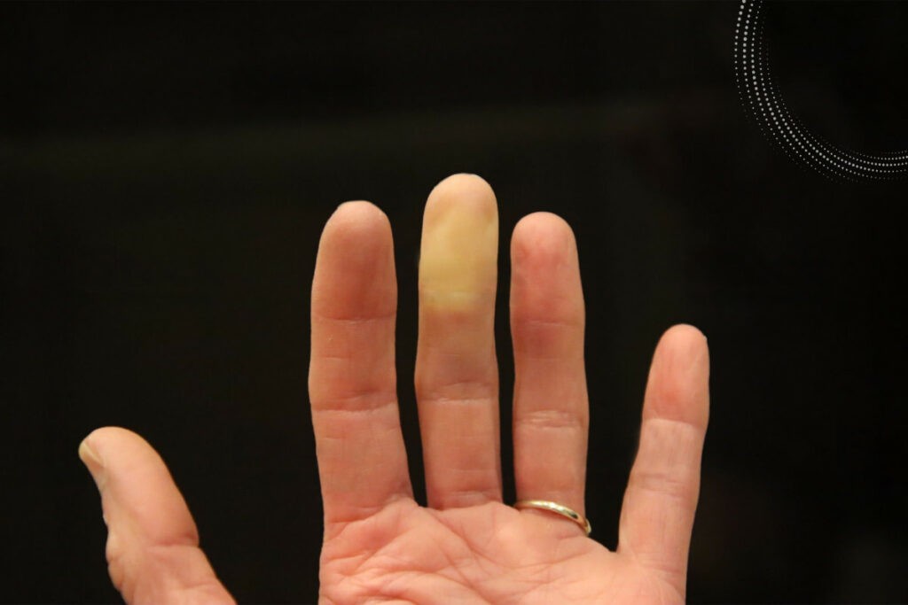 Raynaud's Disease Insights - Blog by Lone Star Neurology