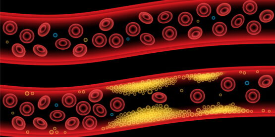 PVD vs PAD: Key Differences and Important Insights