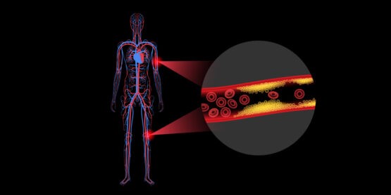 PVD vs PAD: Key Differences and Important Insights