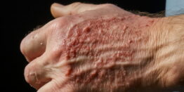 All about treatment of skin lesions in tuberous sclerosis