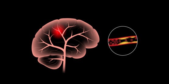 What Is the Difference Between Mini-stroke and Stroke?