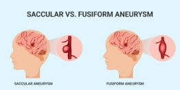 Types of Brain Aneurysm Existing - Lone Star Neurology