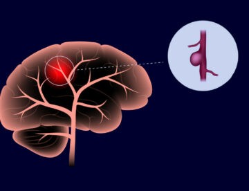 What is an embolic stroke? - Lone Star Neurology