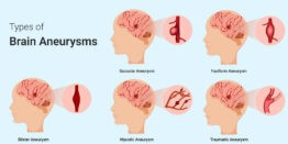 Types of Brain Aneurysm Existing - Lone Star Neurology