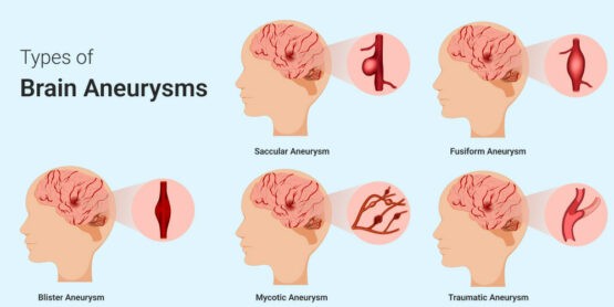 Types of Brain Aneurysm Existing - Lone Star Neurology