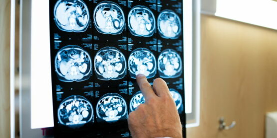 Types of Traumatic Brain Injury - Lone Star Neurology