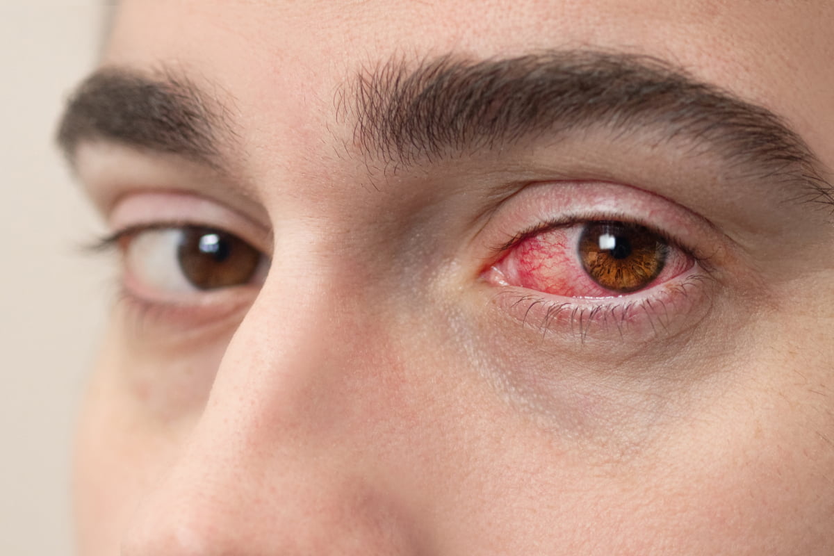 Conjunctivitis: Causes, Symptoms, and Treatment Options