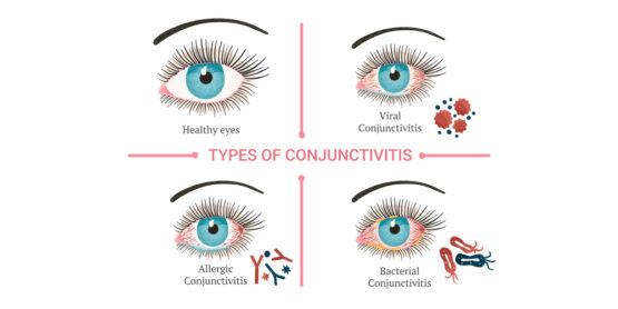 Conjunctivitis: Causes, Symptoms, and Treatment Options