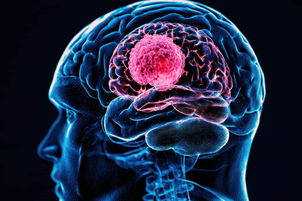Brain Tumors: Early Signs & Advanced Treatment Options